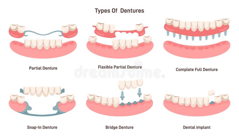 Dental Prosthesis Types Set. Dental Implant, Partial, Snap-in, Bridge ...