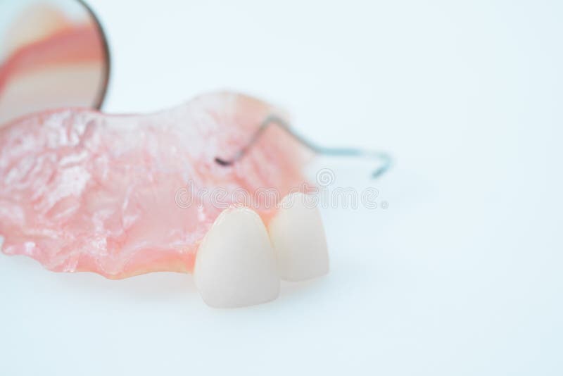 Partial Denture Upper Side. Stock Photo - Image of isolated, side ...