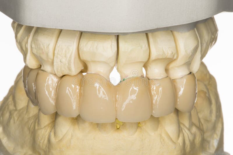 Dental prothesis stock photo. Image of teeth, tooth, dentures - 29676326