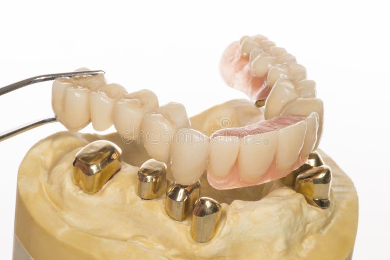 Dental prothesis stock photo. Image of teeth, dentures - 29676532