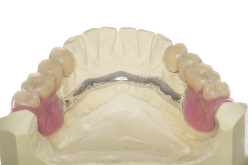 Dental prothesis stock image. Image of denture, oral - 30388027