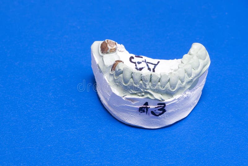 Dental prothetic stock image. Image of teeth, cubic, paradontologist ...