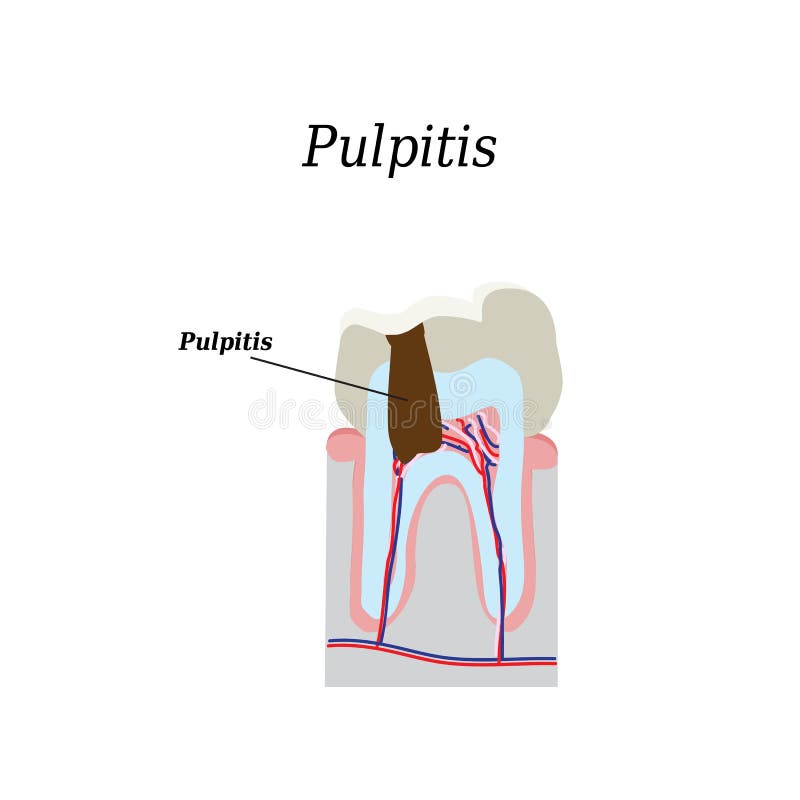 Dental Pulp Stock Illustrations – 1,954 Dental Pulp Stock Illustrations ...