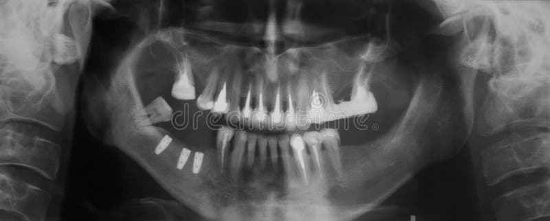 Total Periodontal Bone Loss Stock Photo - Image of radiograph ...
