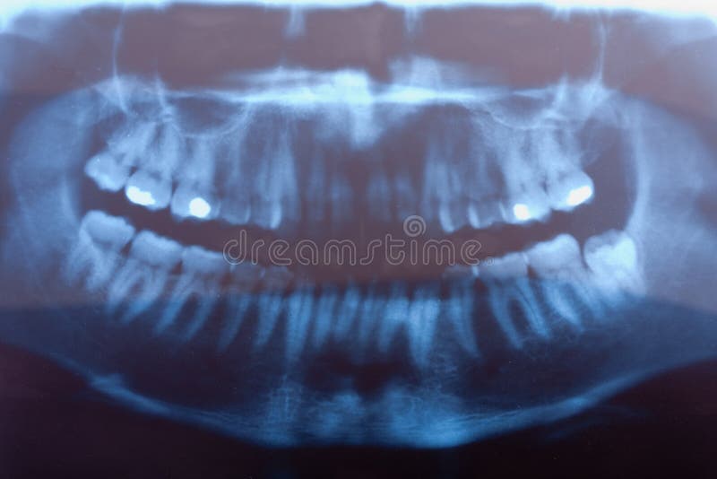 Panoramic Dental X-ray - 31 Teeth Cyan Color Stock Photo - Image of ...