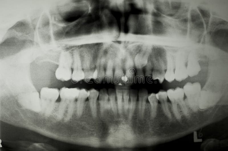 Dental X Ray stock photo. Image of mandible, bones, premolars - 16092938