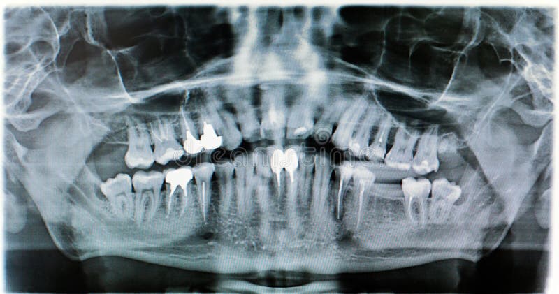 Dental X-Ray stock image. Image of front, white, teeth - 24108655