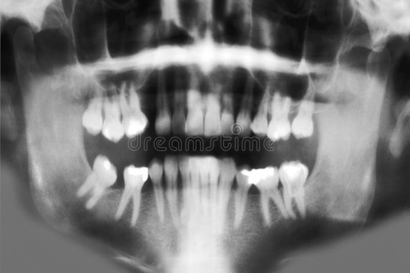 Dental X-Ray - Full Mouth Scan Stock Image - Image of molar, diagnostic ...