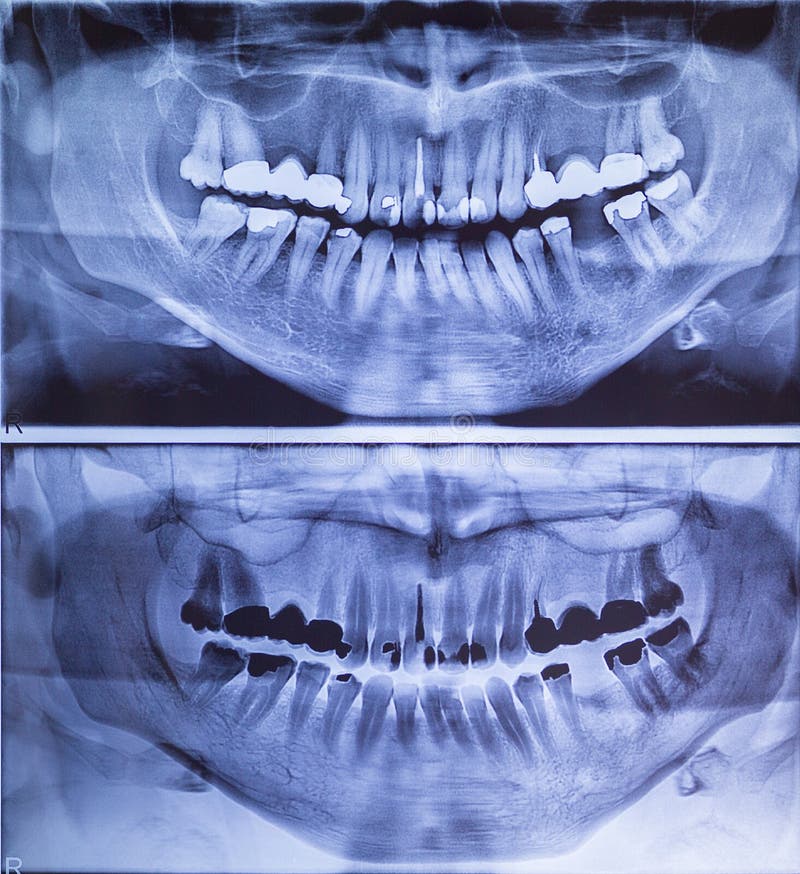 Dental X-Ray panoramic man stock photo. Image of bone - 68816774