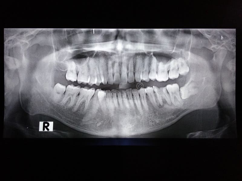 Dental X-Ray Panoramic Rontgen of Wisdom Teeth Stock Photo - Image of ...
