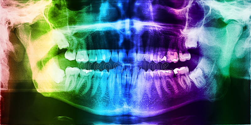 Dental X-Ray Photo of Human Teeth Stock Image - Image of head ...