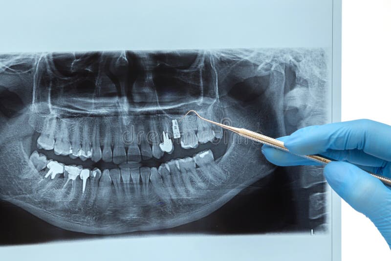 Dental Radiograph Stock Images - Download 406 Royalty Free Photos