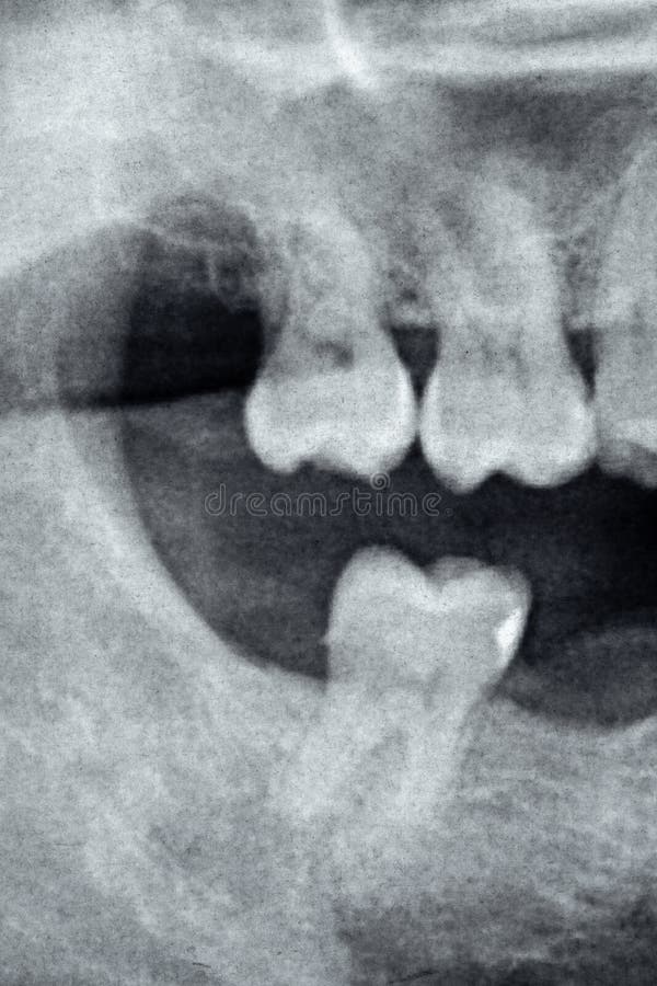 Dental X-Ray of the Right Side of Back Tooth Stock Image - Image of ...