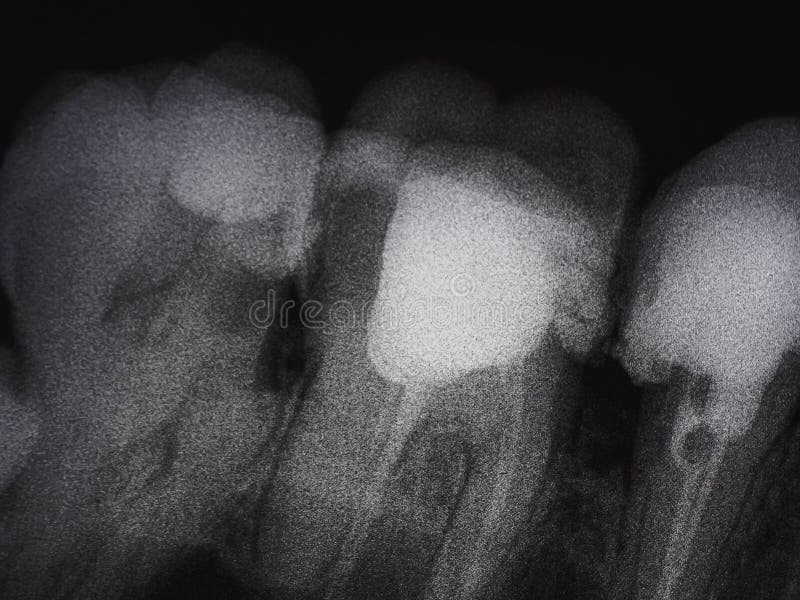 Dental X-ray of Several Bad Molars. Caries Stock Image - Image of sick ...