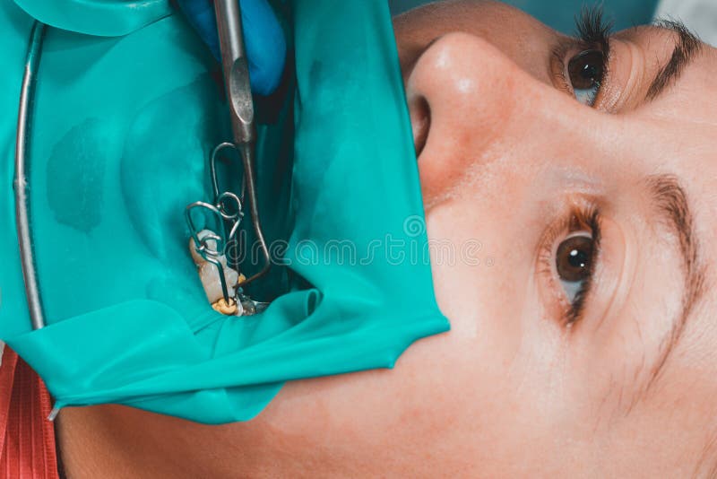 Dental Restoration and Polymerization of Tooth Composite Materials, the ...