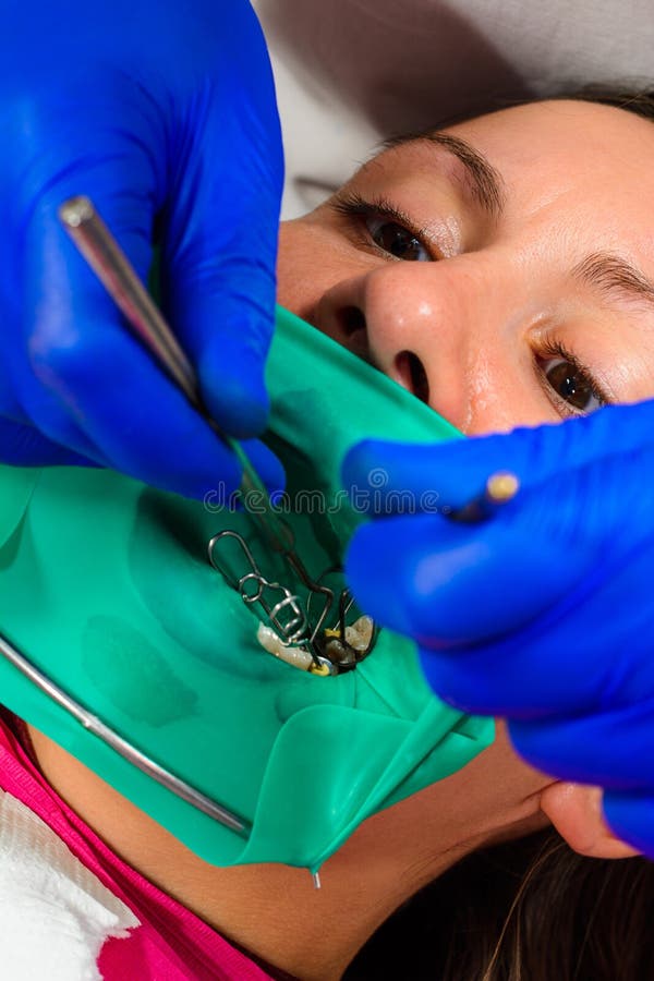 Dental Restoration and Polymerization of Tooth Composite Materials, the ...