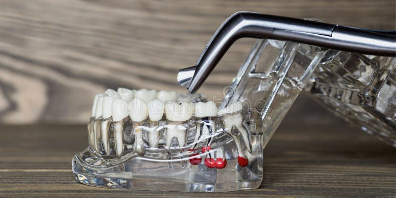 Dental Root Canal Model with Metal Inspection Tool Stock Image - Image ...