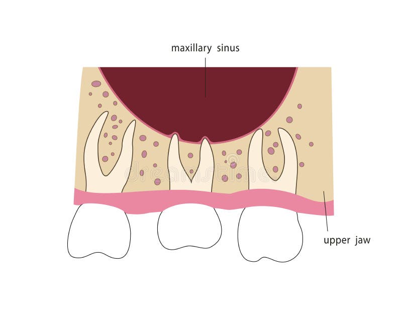 Dental Roots in Maxillary Sinus. Medical Illustration in Flat Style ...