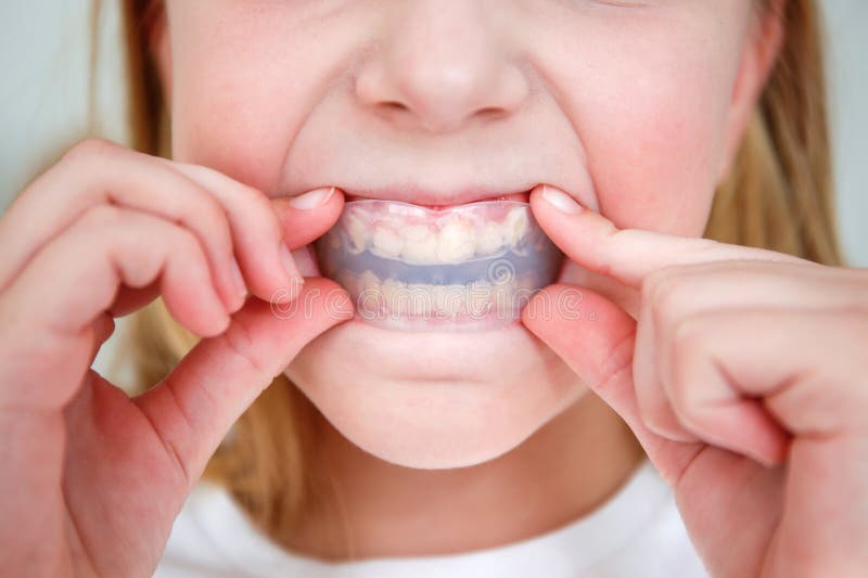 Dental Simulator for Teeth Alignment . the Child Has Mouth Guards on ...