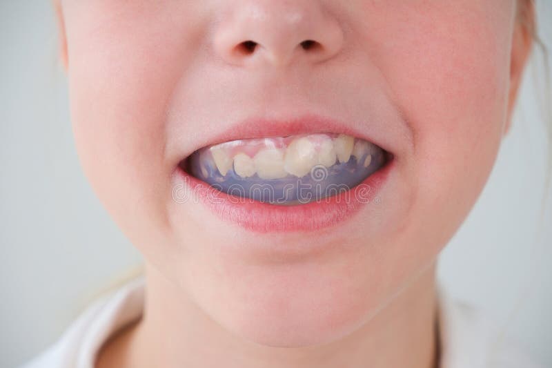 Dental Simulator for Teeth Alignment . the Child Has Mouth Guards on ...