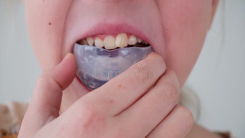 Dental Simulator for Teeth Alignment . the Child Has Mouth Guards on ...