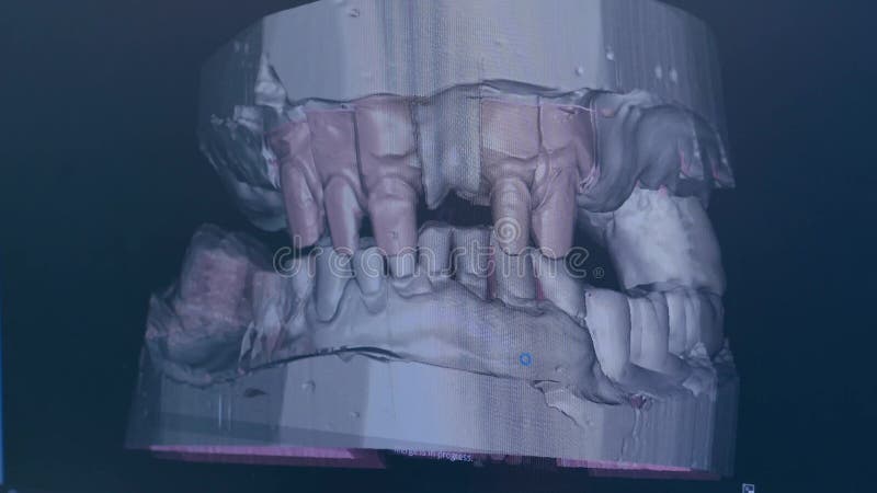 A Dental Technician Uses Software To Design Dentures. Stock Video ...