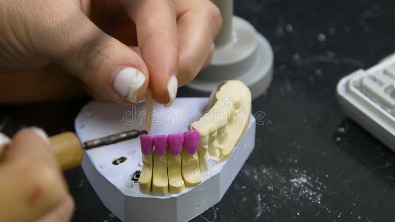 Ceramic Dental Crowns for Implants. Fabrication of Ceramic Dentures in ...