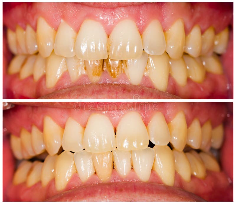 Dental Technicians Work stock photo. Image of macro, dentistry - 37784610