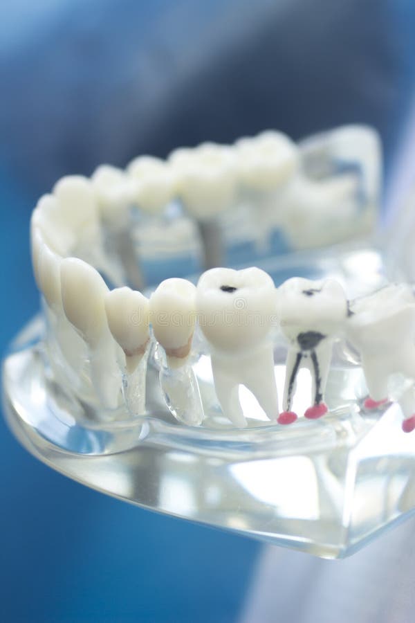 Dental teeth mouth model stock image. Image of filling - 101653111