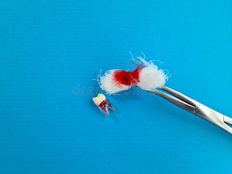Dental Tools and Remove Tooth in Clinic Stock Image - Image of removal ...
