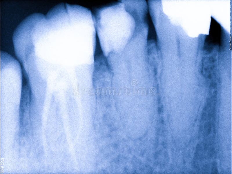 Dental Tooth X-ray Film Macro Stock Photo - Image of skeletal ...