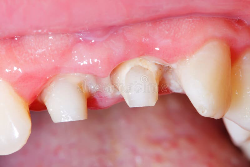 Tooth stub for crown stock photo. Image of discolored - 13823948