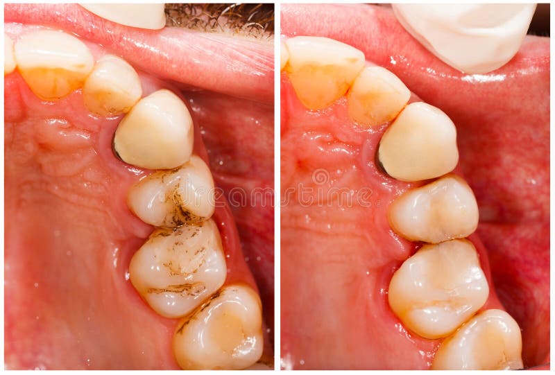 Stitches after Dental Extraction Stock Image - Image of teeth, denture ... Stitches after Dental Extraction Stock Image - Image of teeth, denture ...