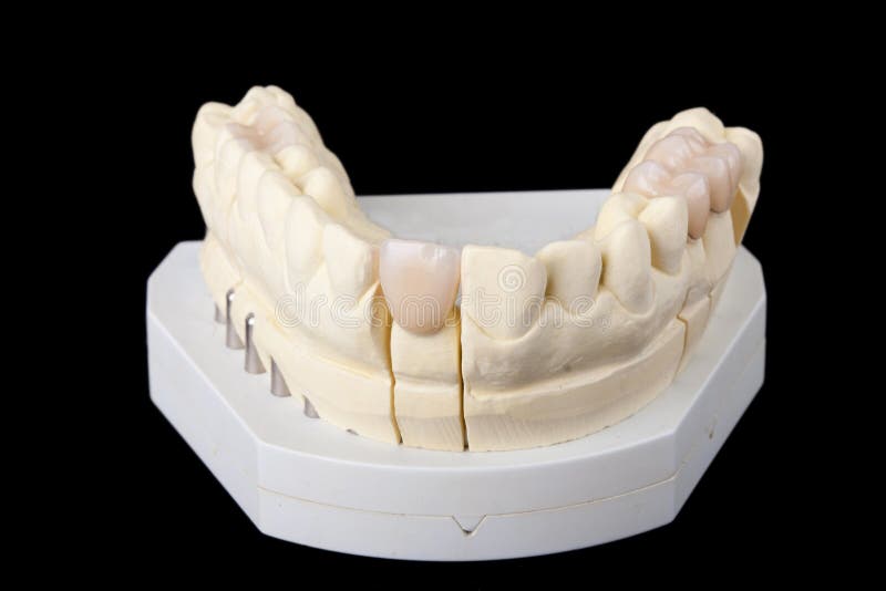 Dental wax model stock photo. Image of bridge, restoration - 17168912