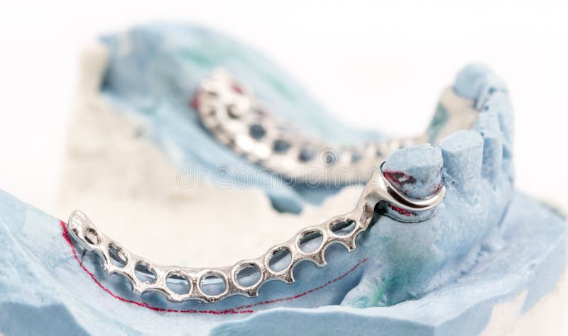 Dental Wire Bending for Make a Partial Denture Stock Image - Image of ...