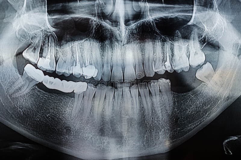 Dental Xray x-ray stock image. Image of sept, teeth - 107221373
