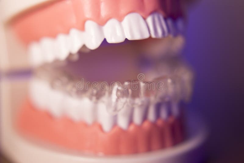Dentier Avec Des Orthodonties Transparentes Photo stock - Image du ...