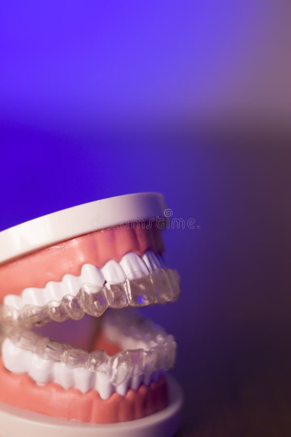 Dentier Avec Des Orthodonties Transparentes Photo stock - Image du ...