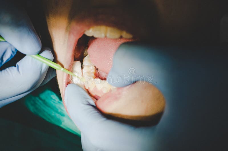 Dentist Checking Up Teeth with Ceramic Brackets Using Dental Tools ...