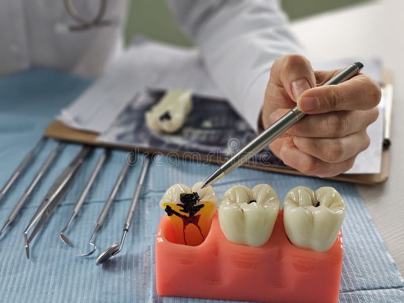 Dentist Demonstrates Dental Filling Techniques Using a Practice Model ...