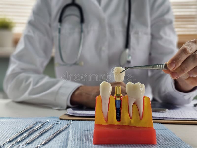 Dentist Demonstrating Dental Implant Procedure Using a Model Stock ...