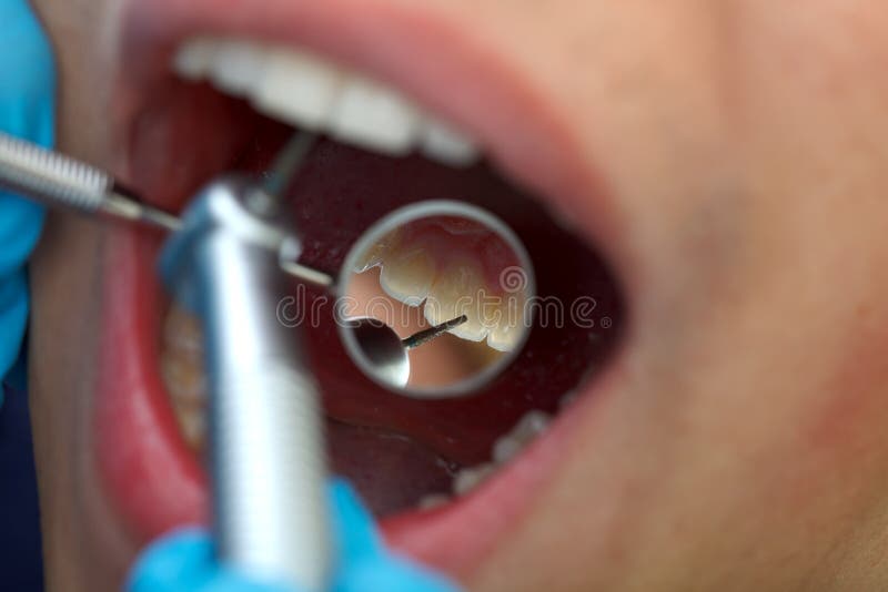 Dental drilling stock image. Image of care, doctor, mask - 30316339