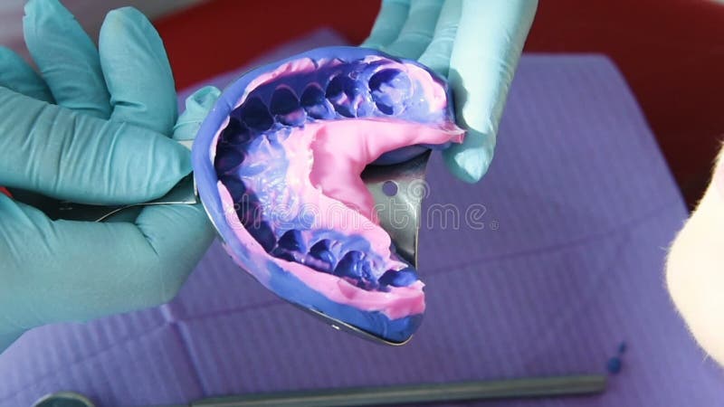 Dentist Makes a Cast of Teeth for Prosthetics Stock Footage - Video of ...