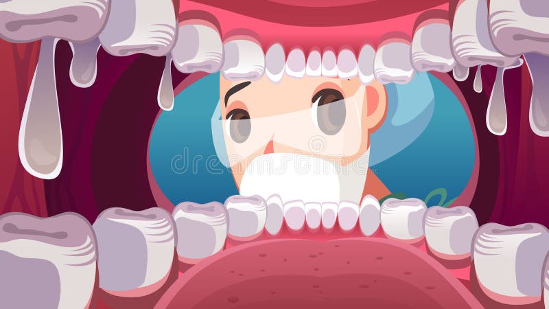 Crowding Teeth Malocclusion, Dental Problem Stock Illustration ...