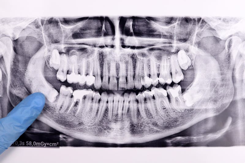 Dentist Points Finger at Wisdom Tooth at Panoramic Dental Tooth X-ray ...