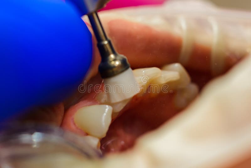 The Dentist Polishes the Teeth with a Drill, a Dental Procedure. Teeth ...