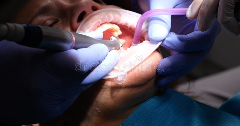 Dentist Prepares Teeth for Installation of Veneers and Crowns Using ...
