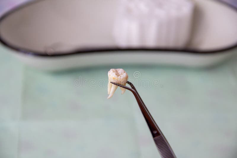 Extracted Tooth with Strange, Curved Root Stock Photo - Image of white ...