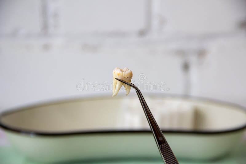 Extracted Tooth with Strange, Curved Root Stock Photo - Image of white ...