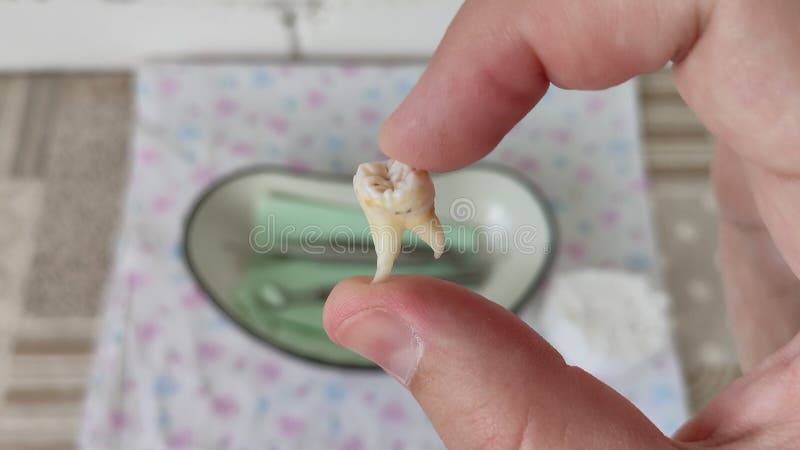 Dentist Shows a Removed Tooth in Hand Stock Photo - Image of dentistry ...